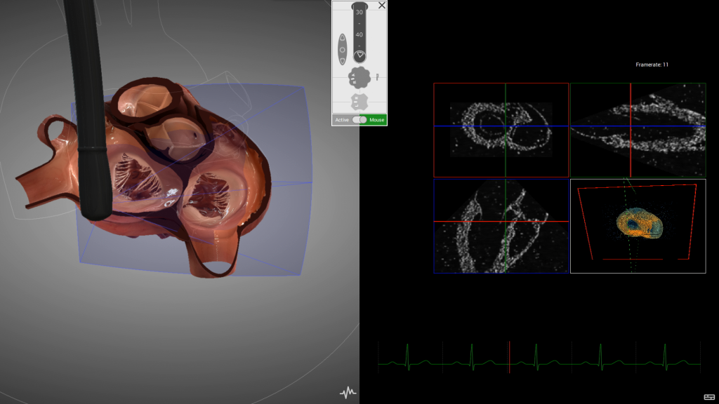 3D Echo comes to HeartWorks - Intelligent Ultrasound 3D Echo comes to HeartWorks - Intelligent Ultrasound